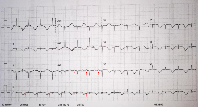T négative – ADMSU