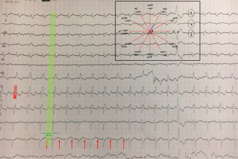 Bloc de Branche – ADMSU