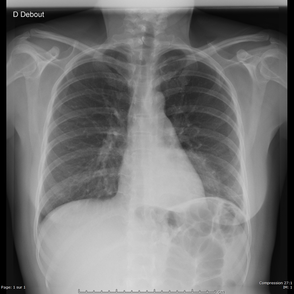 Pneumopathie – ADMSU