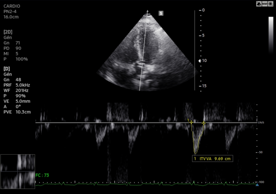 Choc cardiogénique – ADMSU