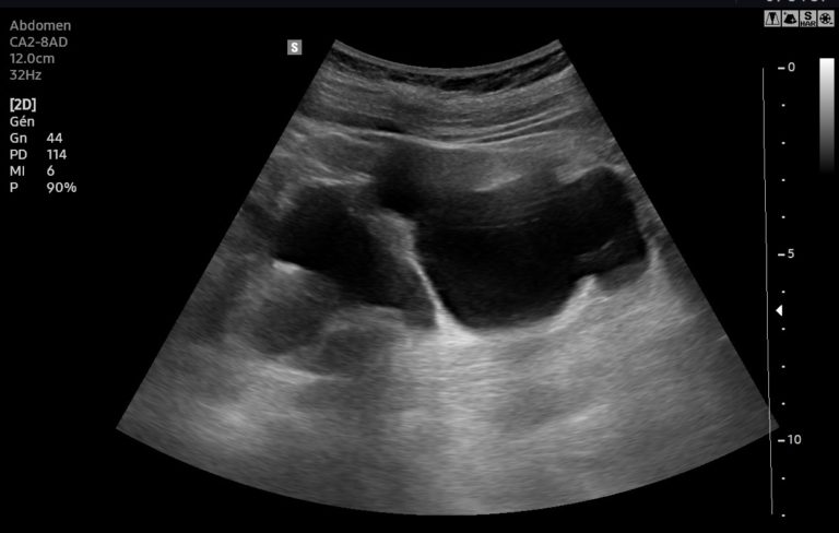 Dilatation des cavités pyélocalicielles – ADMSU