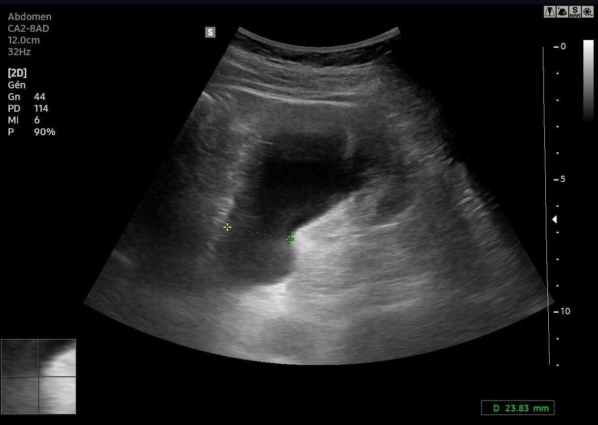 Dilatation des cavités pyélocalicielles – ADMSU