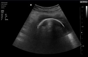 Dilatation des cavités pyélocalicielles – ADMSU