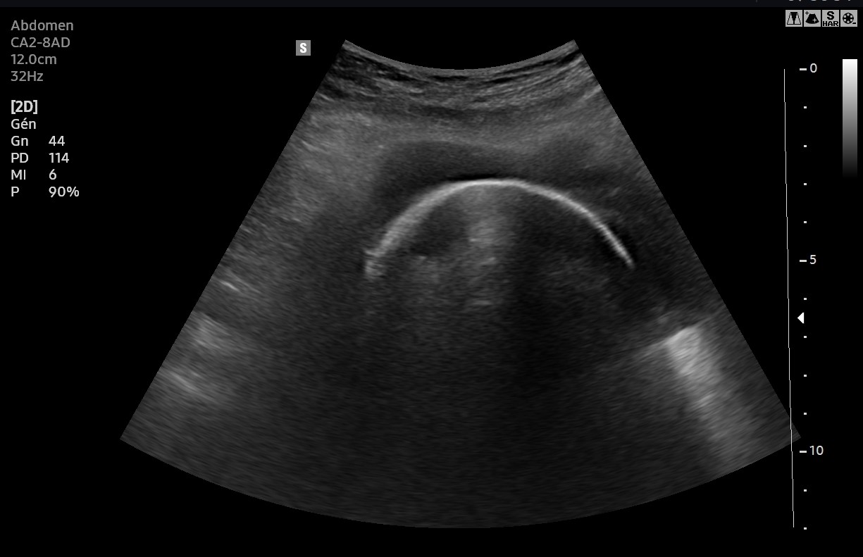 Dilatation des cavités pyélocalicielles – ADMSU