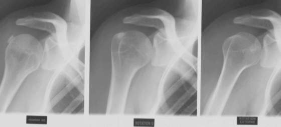 luxation gléno-humérale – ADMSU