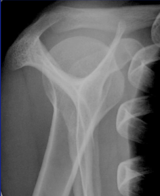 luxation gléno-humérale – ADMSU